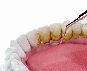What Is Calculus on Teeth? | Optimal Dental Health