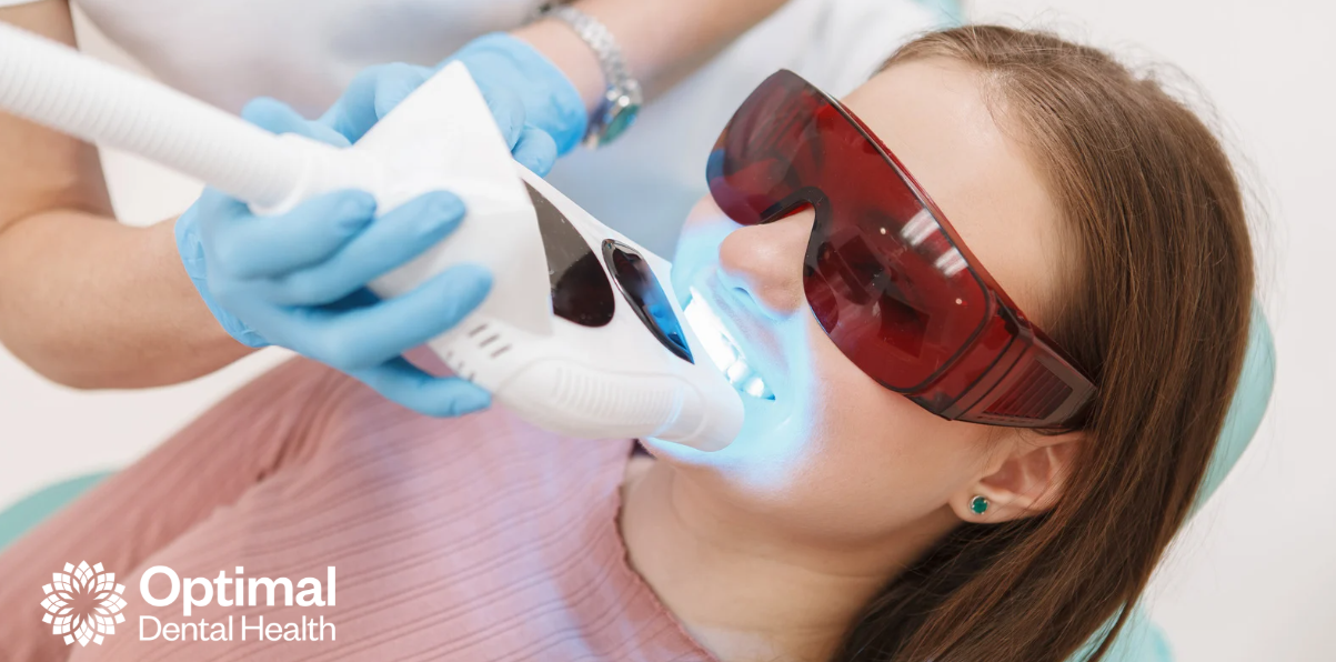 Teeth Whitening: Home Whitening vs. In-Surgery Whitening
