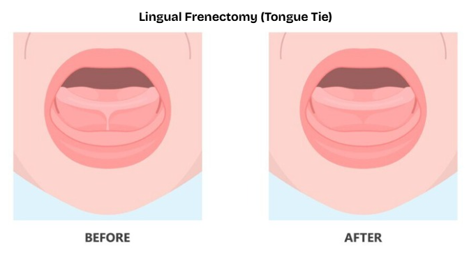 What Are Tongue Ties & Lip Ties? A Complete Guide | Optimal Dental Health